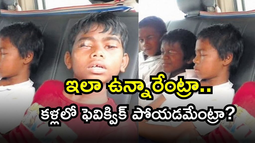 Odisha Feviquick Incident: పిల్లల కళ్లలో ఫెవిక్విక్ పోసిన క్లాస్ మేట్స్